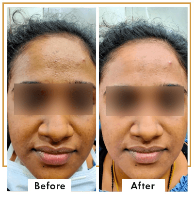 Before & After - Viva Aesthetic Clinic