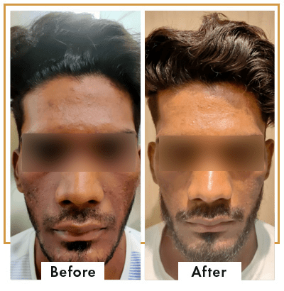 Before & After - Viva Aesthetic Clinic