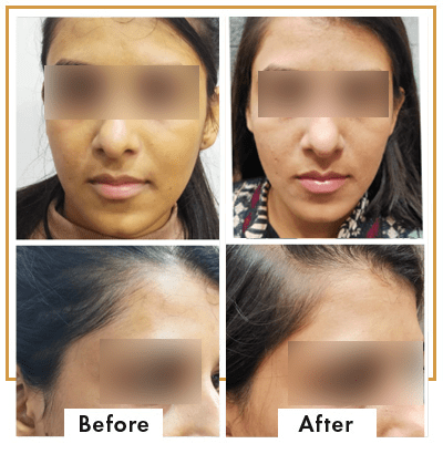 Before & After - Viva Aesthetic Clinic