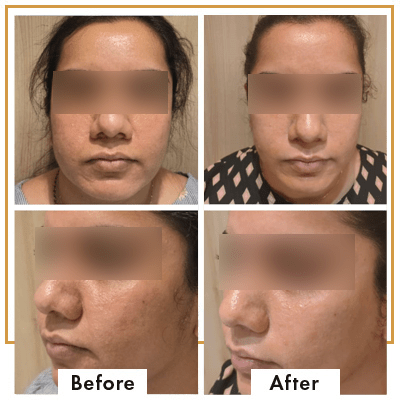 Before & After - Viva Aesthetic Clinic