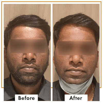 Before & After - Viva Aesthetic Clinic