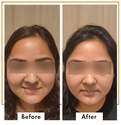 Before & After - Viva Aesthetic Clinic