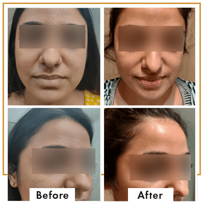 Before & After - Viva Aesthetic Clinic