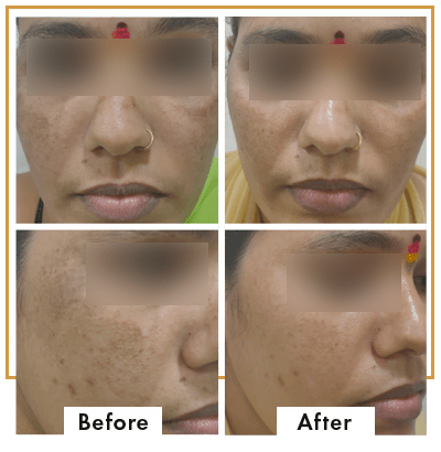 Before & After - Viva Aesthetic Clinic