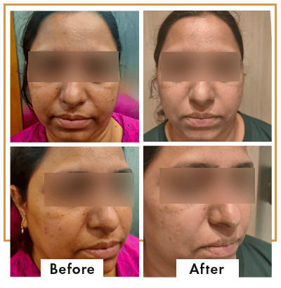 Before & After - Viva Aesthetic Clinic