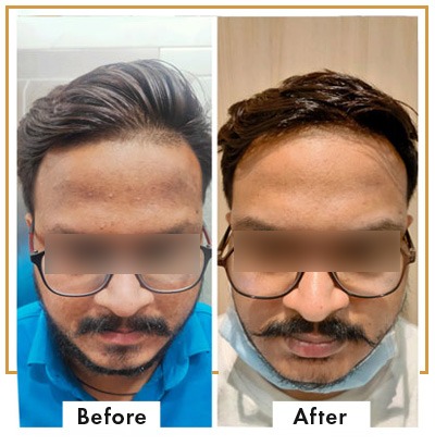 Before & After - Viva Aesthetic Clinic