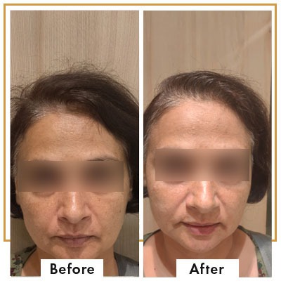 Before & After - Viva Aesthetic Clinic