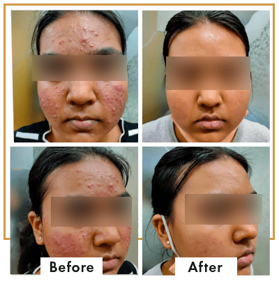 Before & After - Viva Aesthetic Clinic