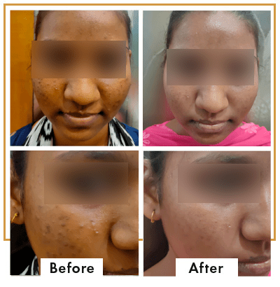 Before & After - Viva Aesthetic Clinic