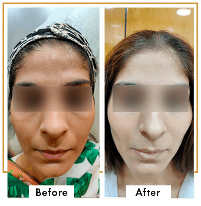 Before & After - Viva Aesthetic Clinic