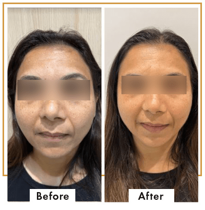 Before & After - Viva Aesthetic Clinic